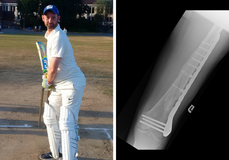 Club cricketer back at the crease 10 weeks after leg amputation
